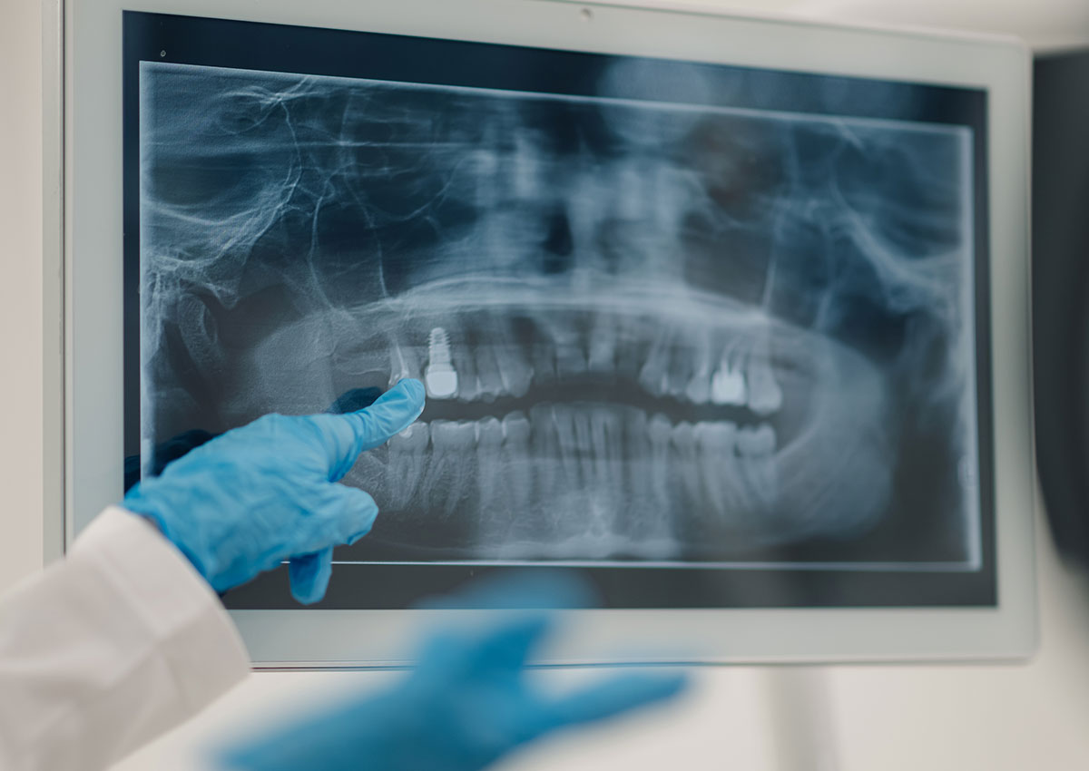 Digital Dental Implants: Precision, Comfort, and Confidence in Modern ...