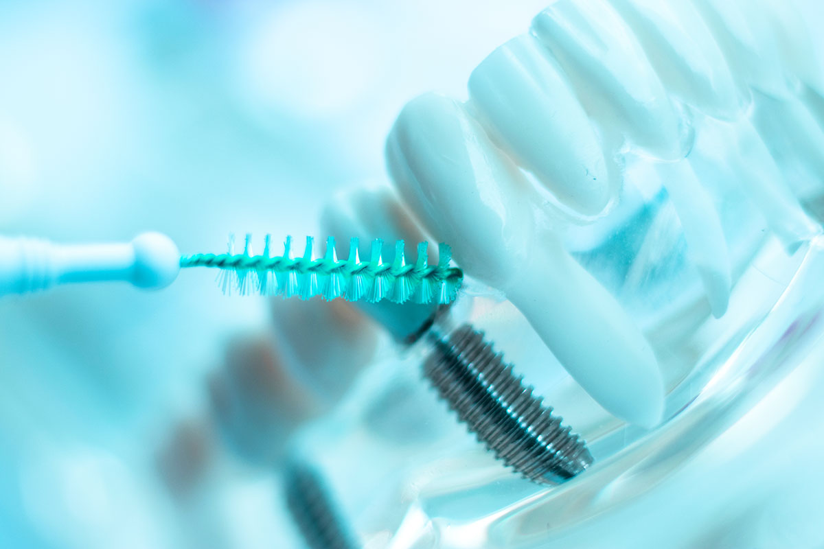 How to Properly Care for Dental Implants: Flossing and Cleaning Tips ...